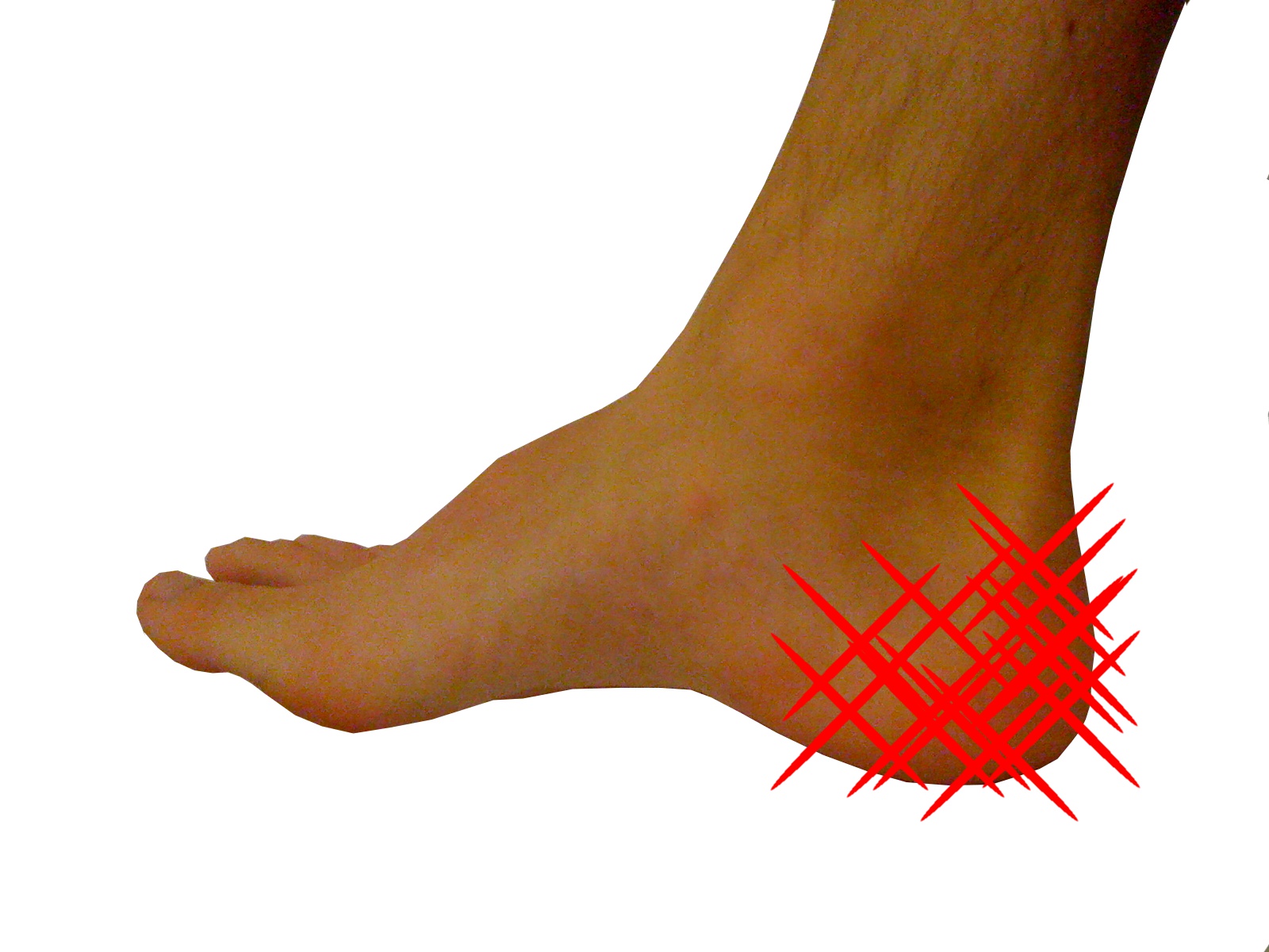 bartholomew-way-clinicsevers-disease-treatment-at-horsham-henfield