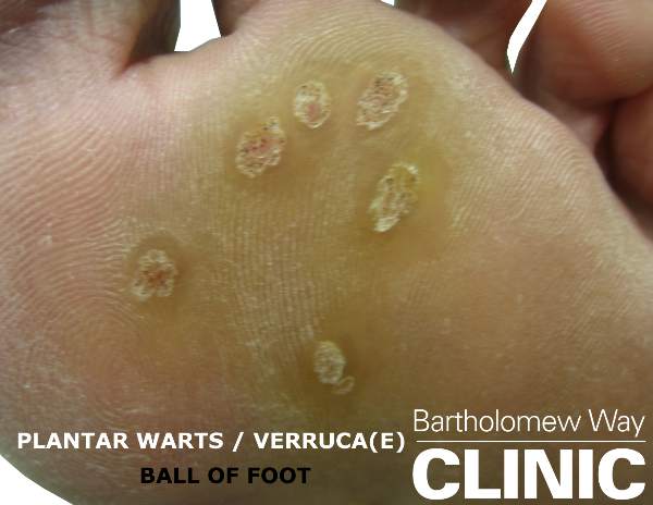Bartholomew Way Clinic | Verruca or Wart? What is this on my foot?